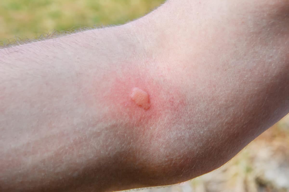 Why Do Mosquito Bites Itch?