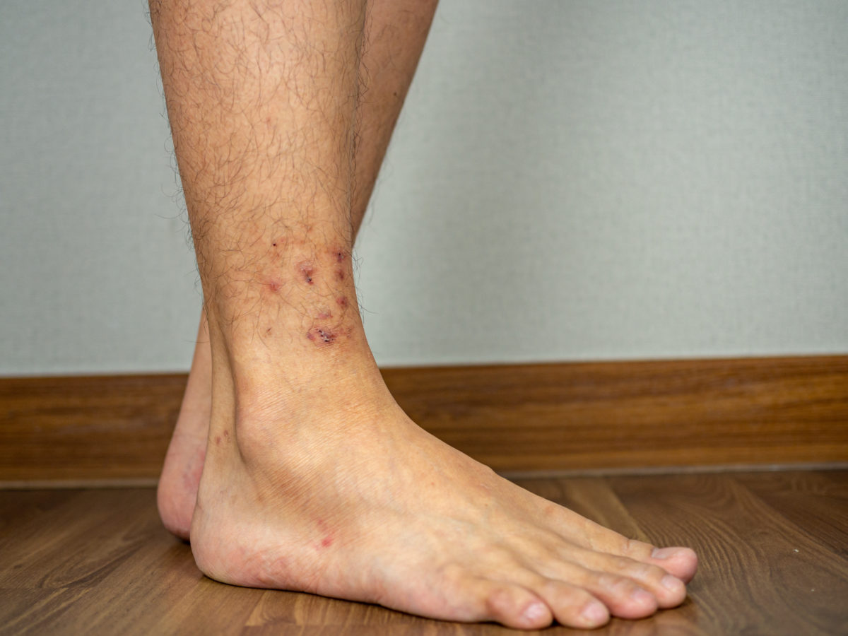 8 Signs of a Flea Infestation